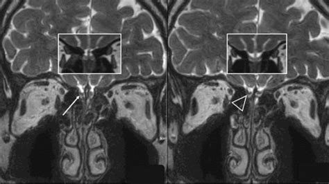 Olfactory Nerve Mri