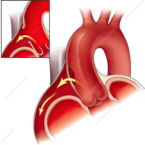 Aortic Rupture Illustration Stock Image C0593331 Science Photo Library
