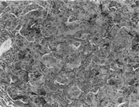 Pulmonary Adenocarcinoma Demonstrating Pleomorphic Epithelial Cells