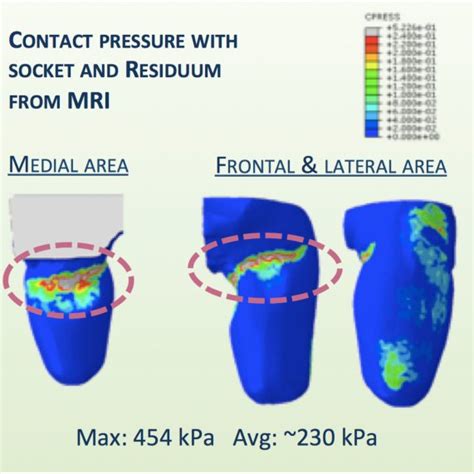 Pdf Design And Additive Manufacturing Of Lower Limb Prosthetic Socket