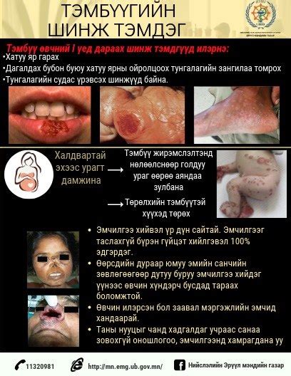 Монголчууд тэмбүү өвчинд баригдаж “дуусах нь” Uuhai Mn