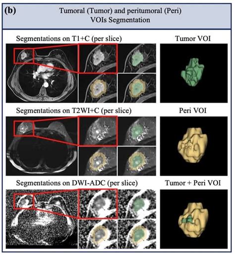 A Noninvasive Tool Based On Magnetic Resonance Imaging Radiomics For The Preoperative Prediction