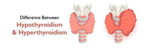 Key Differences Between Hypothyroidism And Hyperthyroidism