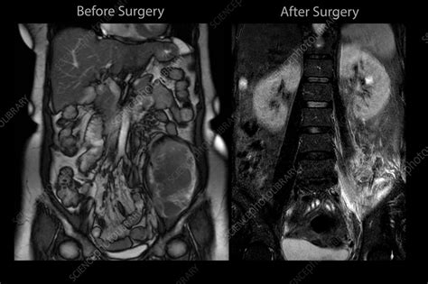 Dedifferentiated Liposarcoma Before And After Surgery Ct Scans Stock Image F0425802