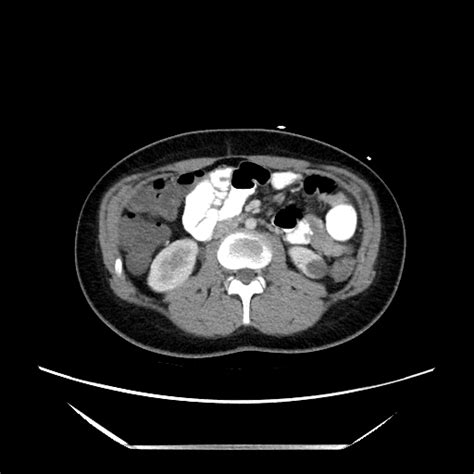 Filecrohns Disease Terminal Ileitis Fistulizing Radiopaedia 98245