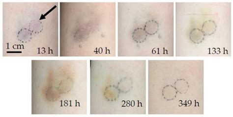Pulsed Photothermal Radiometric Depth Profiling Of Bruises By 532 Nm