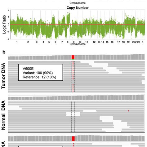 Whole Exome And Transcriptome Sequencing Reveals Over Representation Of