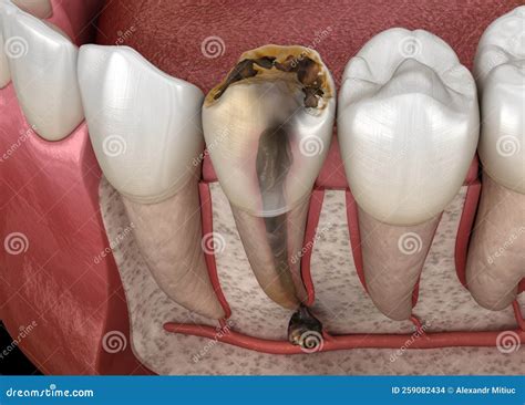 Periostitis Tooth Lump On Gum Above Tooth Medically Accurate Dental
