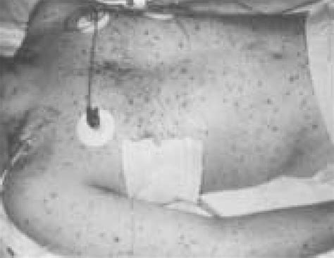 Generalized Maculovesicular Rash In A 32 Year Old Male Patient With