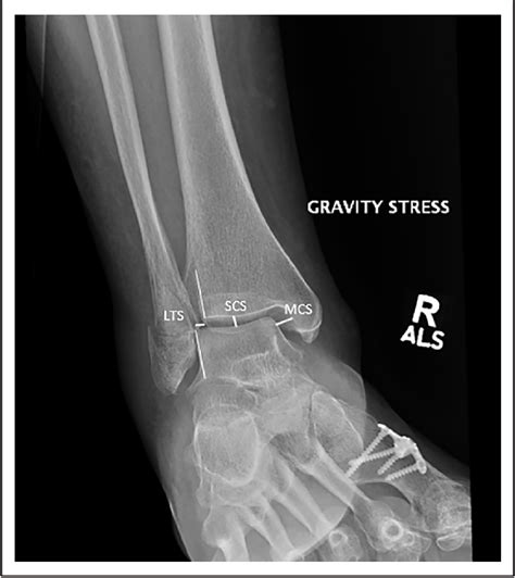 Figure 2 From Measuring Deltoid Insufficiency After Supination External Rotation Ankle Fracture