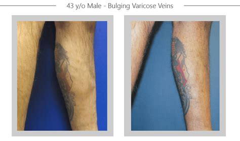 Texas Vein Centers Vein Treatment Beaumont And Corpus Christi