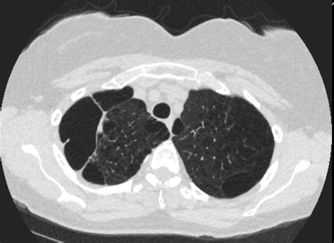 Emphysema Ct The Common Vein