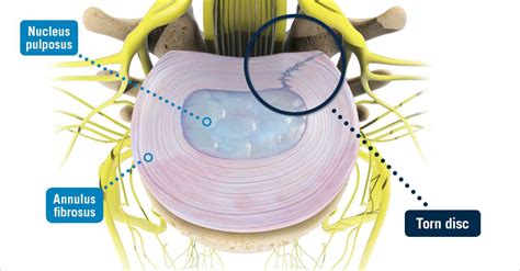 Torn Disc Usa Spine Care Laser Spine Surgery