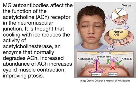 Ptosis Case Ranatomy