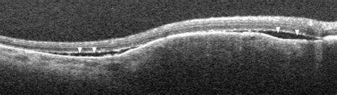 Right Eye At Presentation A Fundus Photograph Showing Choroidal Mass