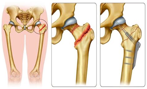 Managing Vs Treating A Femoral Neck Fracture