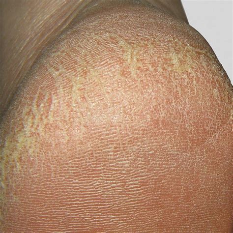 What Causes Dry Feet And How Can I Treat It Eucerin Uk