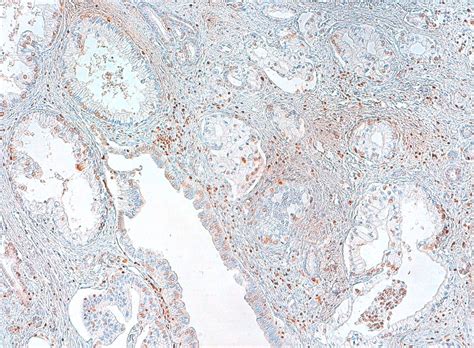 Runx3 As A Potential Predictor Of Metastasis In Human Pancreatic Cancer