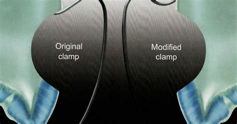 Class V Composite Restoration Non Carious Lesion Dental Esthetics