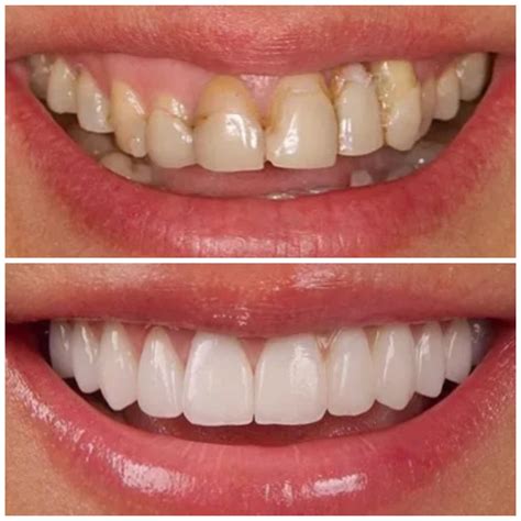 Veneers Before And After Buck Teeth