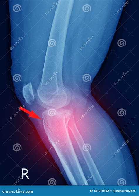 X Ray Knee Fracture Proximal Metaphysis Of Tibia Depressed Fracture Of Lateral Tibial Plateau