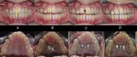 Upper Midline Correction In Conjunction With Rapid Maxillary Expansion