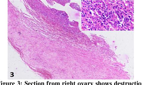 Figure 2 From Bilateral Xanthogranulomatous Oophoritis And Salpingitis