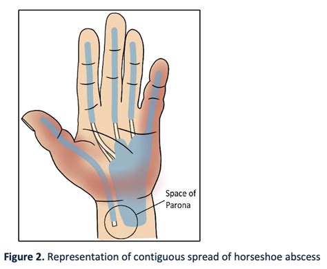 Infective Flexor Tensosynovitis Flexor Sheath Infection Mind The Bleep