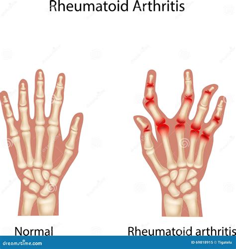 Cartoon Illustration Of Rheumatoid Arthi Stock Vector Illustration Of