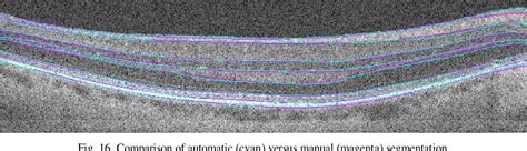 Figure 1 From Automatic Segmentation Of Seven Retinal Layers In Sdoct Images Congruent With