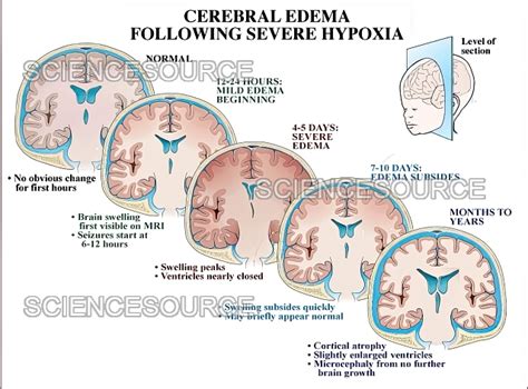 Cerebral Edema Following Hypoxia In Ne Stock Image Science Source
