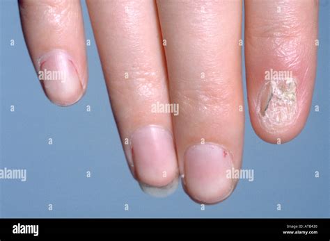 Candidosi Mucocutanea Cronica Unghie Onicomicoza Pedichiură