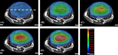 Difference In Dose Distributions In Patient Between Con IMRT Plan And Download Scientific