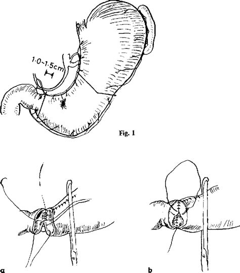 Pylorus Preserving Procedure In Partial And Total Gastrectomy Semantic Scholar
