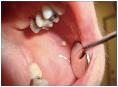 Salivary Gland Pathology Mind The Bleep