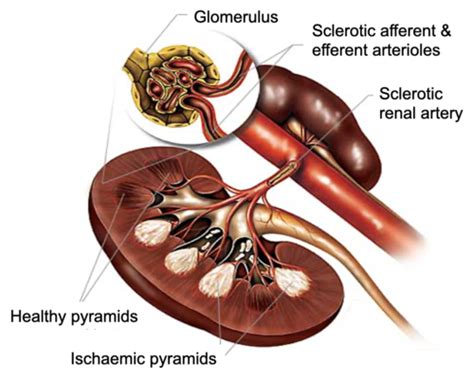 Diabetic Nephropathy Flashcards Quizlet