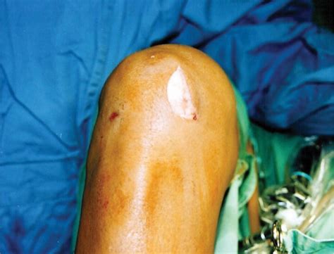 Post Arthroscopic Approach Skin Incision In The Medial Parapatellar Download Scientific