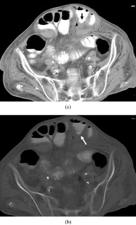 Figure 4 From Abdominal Ct Findings In Small Bowel Perforation