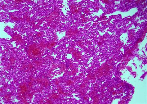 Histopathology In Primary Atelectasis In Infants And Risk Factors