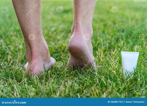 Men S Heels Feet With Dry Skin And Scaly With Cream On Grass Stock