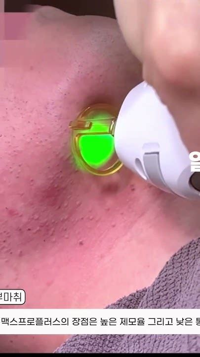 수염 밀어도 다시 난다면 수원남자수염제모로 해결｜젠틀맥스프로플러스 제모 효과 수원남자수염제모 수염제모 레이저제모 젠틀