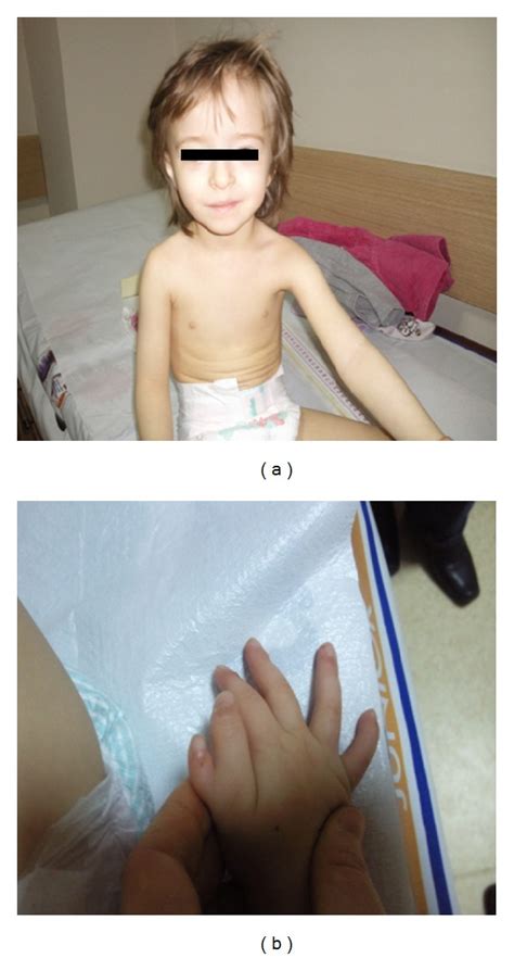 Cernunnos Xlf Deficiency A Syndromic Primary Immunodeficiency Pmc