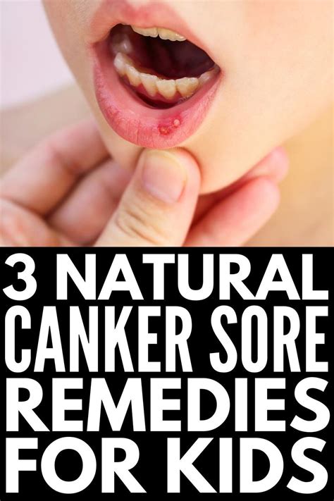 Natural And Effective 9 Canker Sore Remedies That Work Fast Canker Sore Remedy Canker Sore