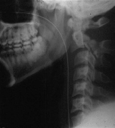 Pseudosubluxation Of The Cervical Spine Spine Orthobullets