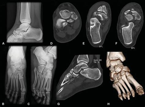 Navicular Fracture Foot Treatment Quotes Home