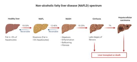 Non Alcoholic Fatty Liver Disease Nafld Spectrum Biorender Science