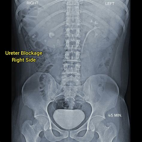 Ureter Blockage Shortsvideo Youtube
