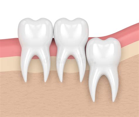 Wisdom Teeth Vertical Impaction Stock Vector Illustration Of Icons Care 61072867