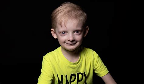 Ectodermal Dysplasia