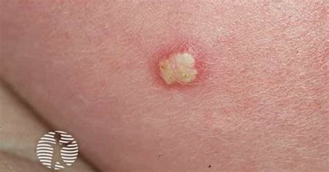 Calcinosis Cutis Image